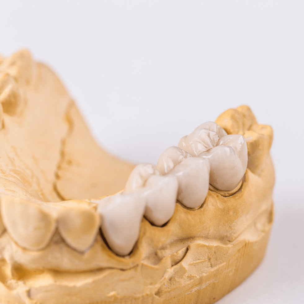 Protesi dentaria fissa | Cesmed Medica